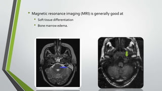 Malignant Otitis Externa/ Skull Base osteomyelitis | PPTX