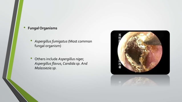 Malignant Otitis Externa/ Skull Base osteomyelitis | PPTX