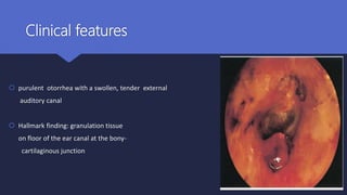 Malignant Otitis Externa | PPTX