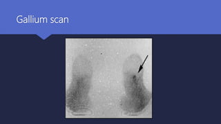 Malignant Otitis Externa | PPTX
