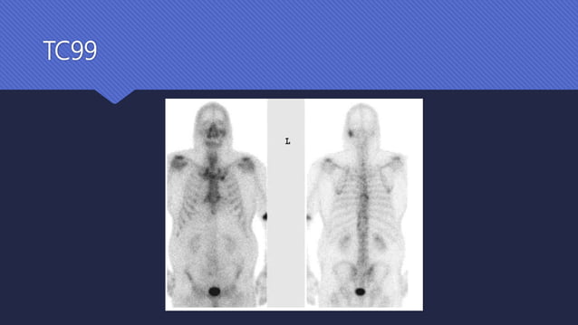 Malignant Otitis Externa | PPTX