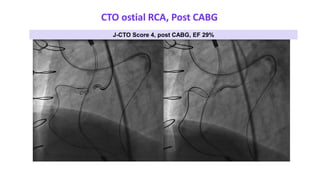 15th Experts Live CTO: Mohamed Ayoub: Aorto-ostial CTO | PDF