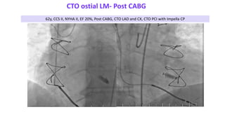 15th Experts Live CTO: Mohamed Ayoub: Aorto-ostial CTO | PDF