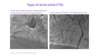 15th Experts Live CTO: Mohamed Ayoub: Aorto-ostial CTO | PPT