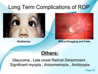 retinopathy of prematurity | PPT