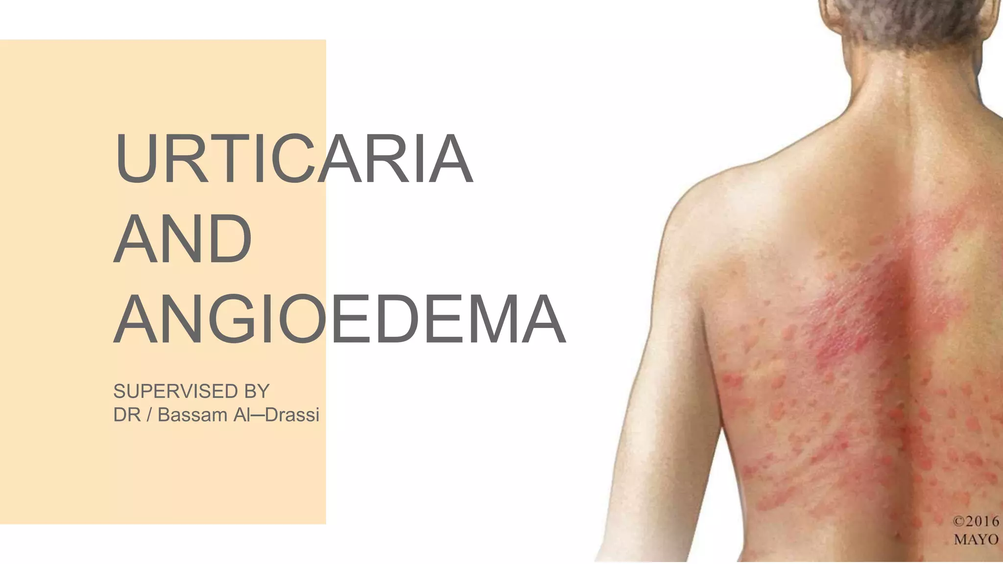 Urticaria | PPTX