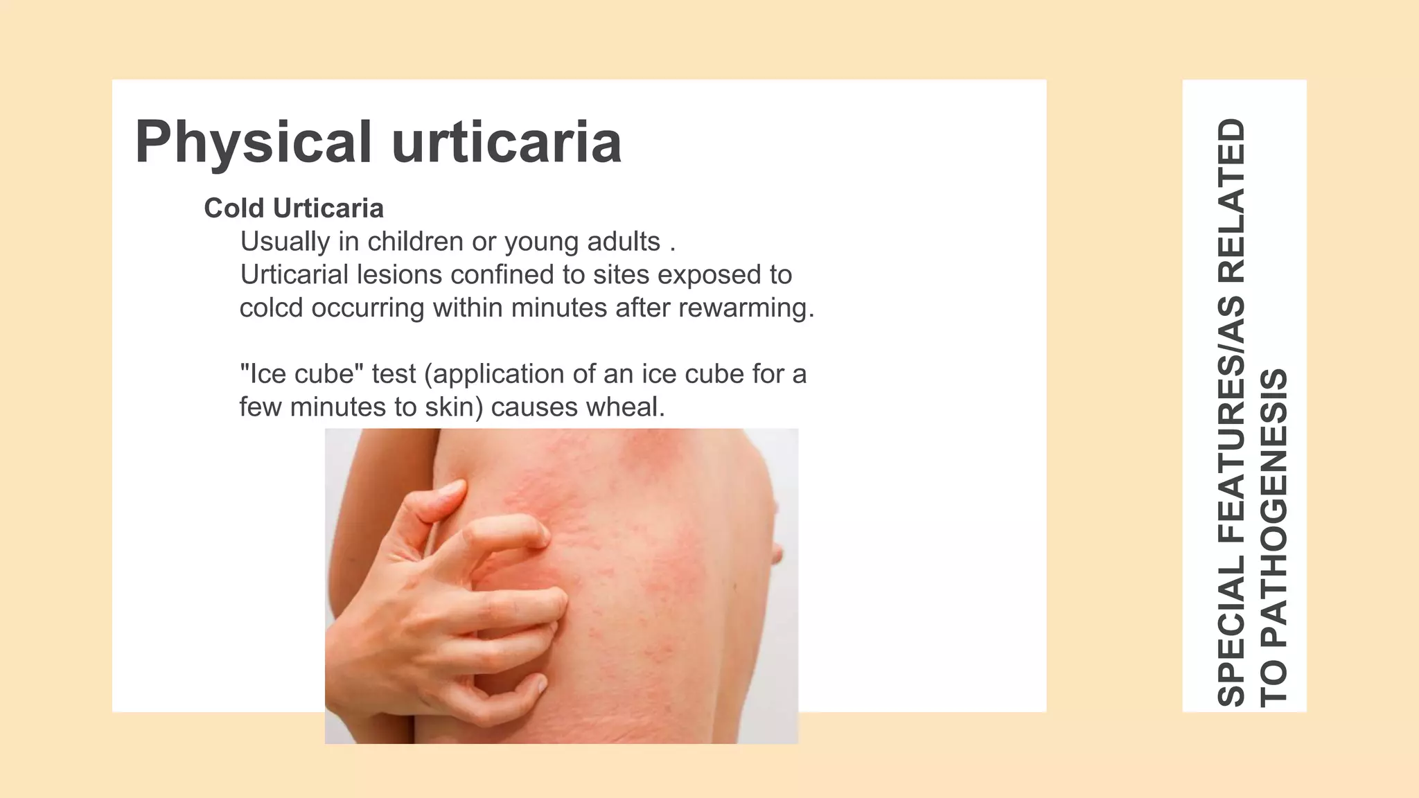 Urticaria | PPTX