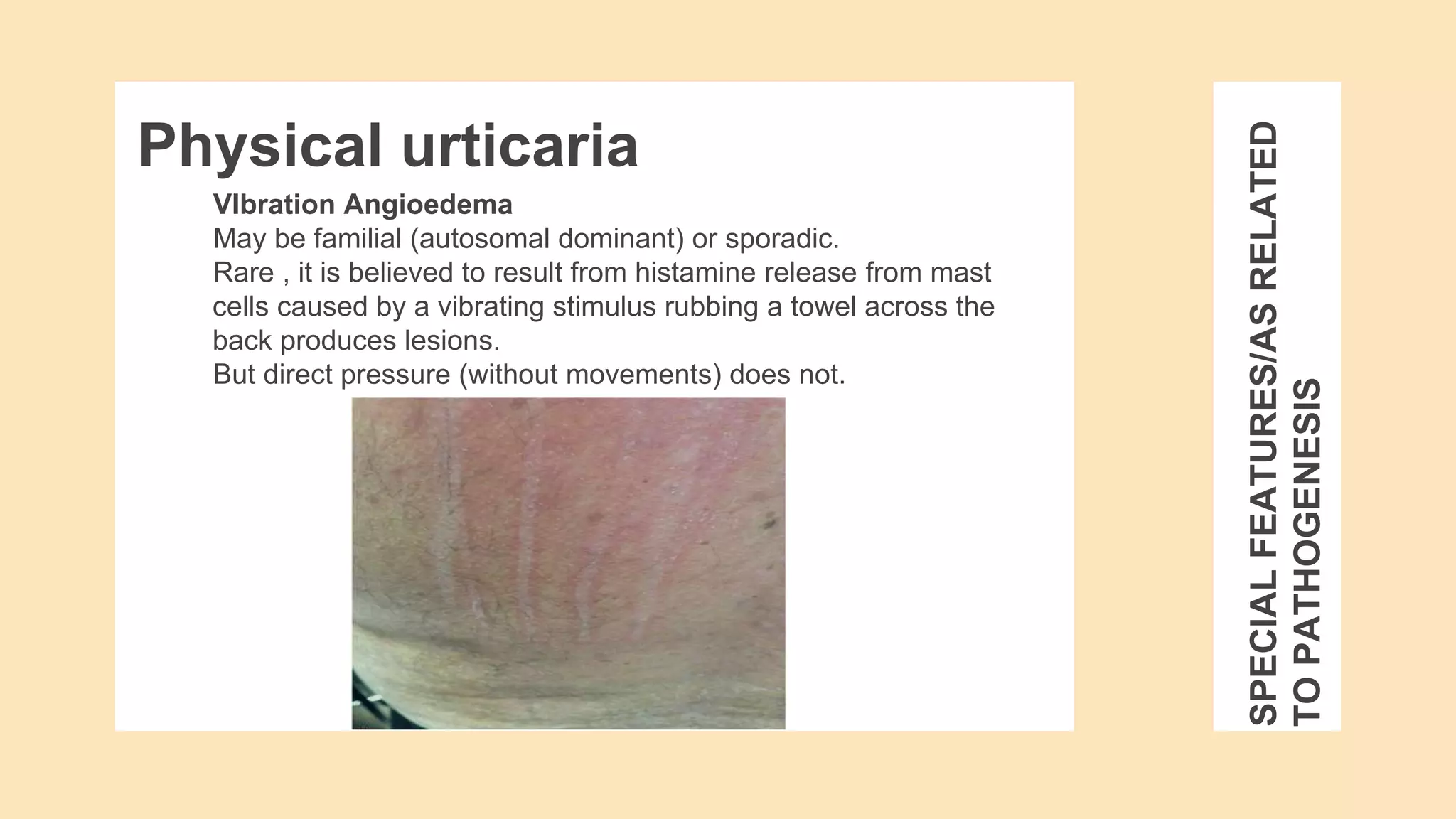 Urticaria | PPTX