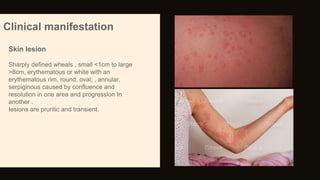 Urticaria | PPTX