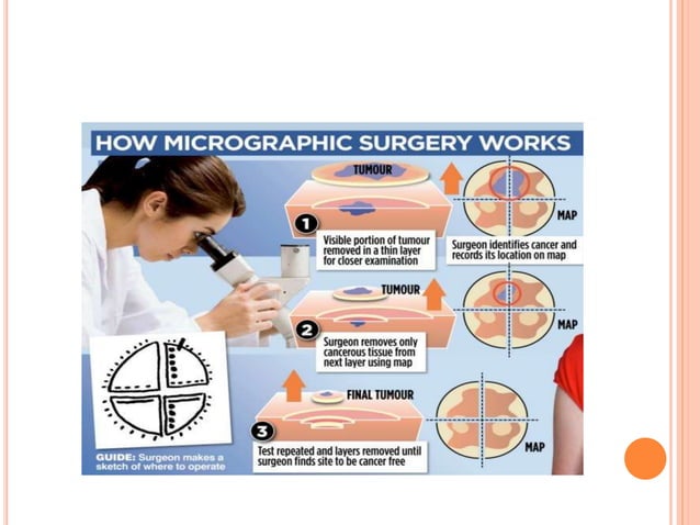 Mohs micrographic surgery CPT CODING-2017 | PPTX | Surgery | Medical Health