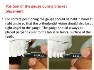 bracket gauges and placement | PPTX