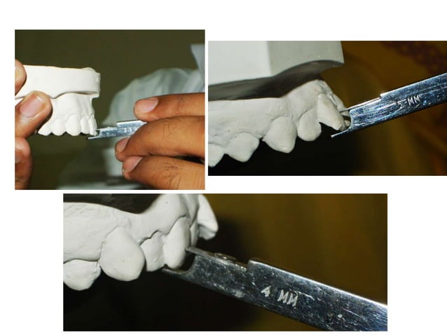 bracket gauges and placement | PPTX | Dental Health | Diseases and ...