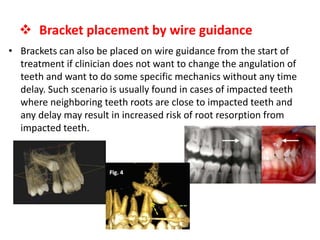 bracket gauges and placement | PPTX