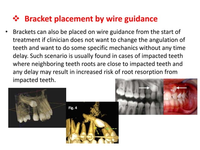 bracket gauges and placement | PPTX | Dental Health | Diseases and ...