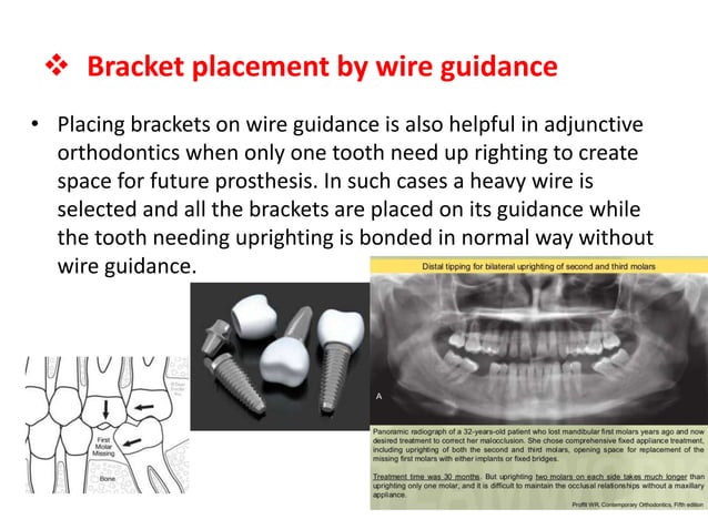 bracket gauges and placement | PPTX | Dental Health | Diseases and ...