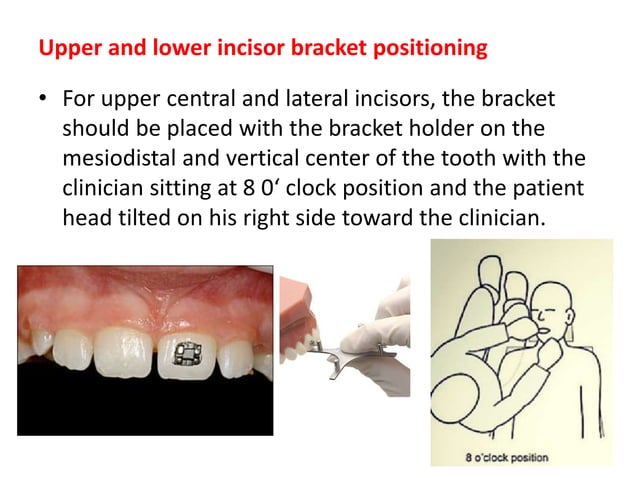 bracket gauges and placement | PPTX | Dental Health | Diseases and ...