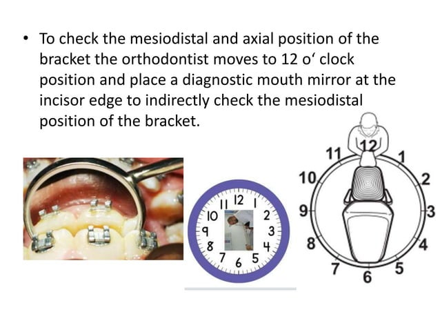 bracket gauges and placement | PPTX | Dental Health | Diseases and ...