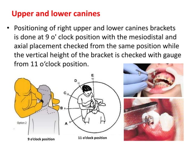 bracket gauges and placement | PPTX | Dental Health | Diseases and ...