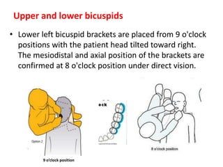 bracket gauges and placement | PPTX