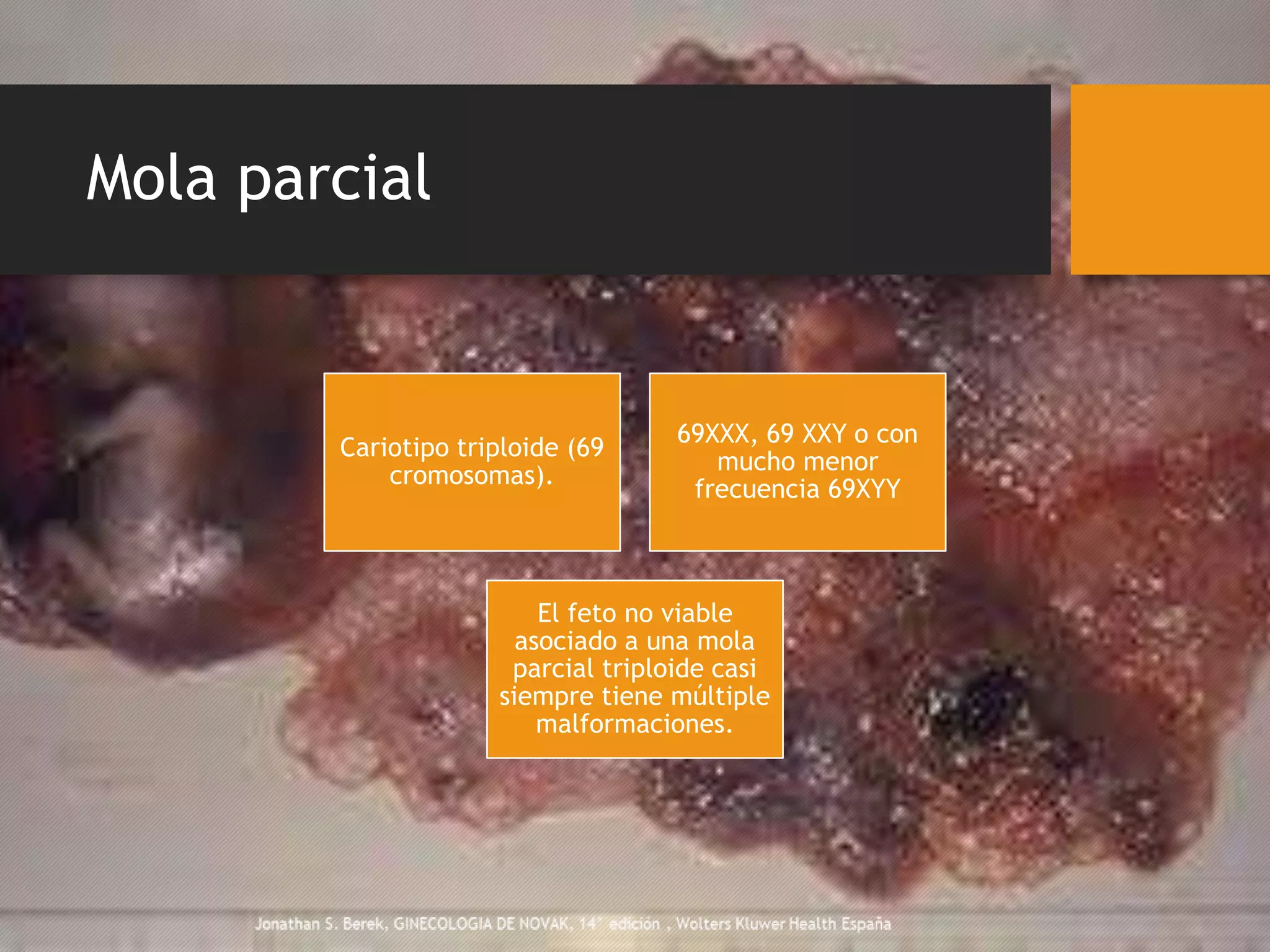 Mola hidatidiforme | PPTX