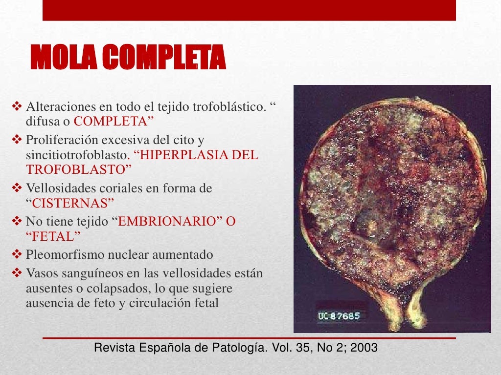 Mola hidatidiforme mia