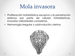 MOLA HIDATIFORME | PPTX