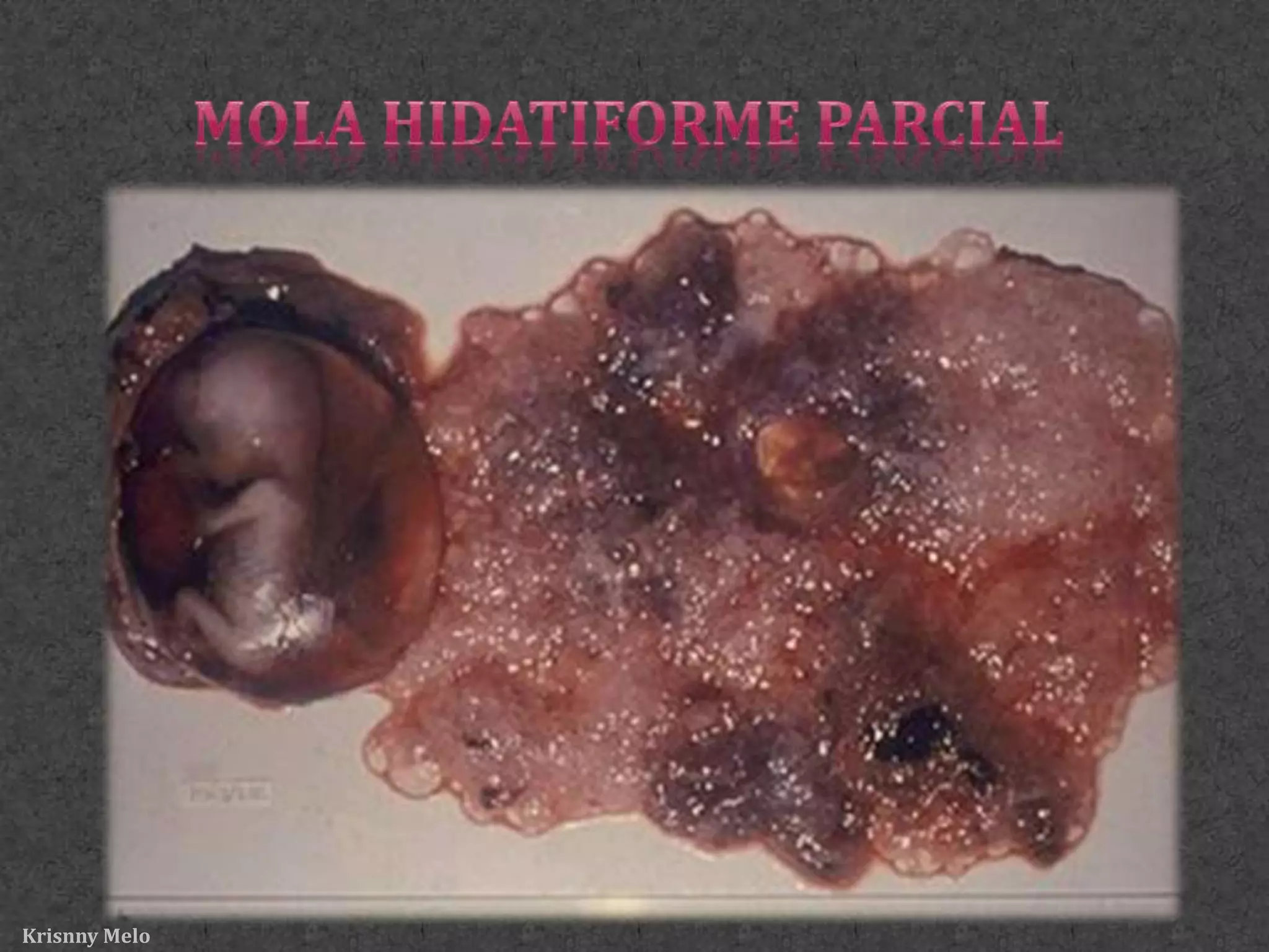 Embarazo Molar - Mola Hidatiforme | PPTX | Pregnancy | Reproductive Health