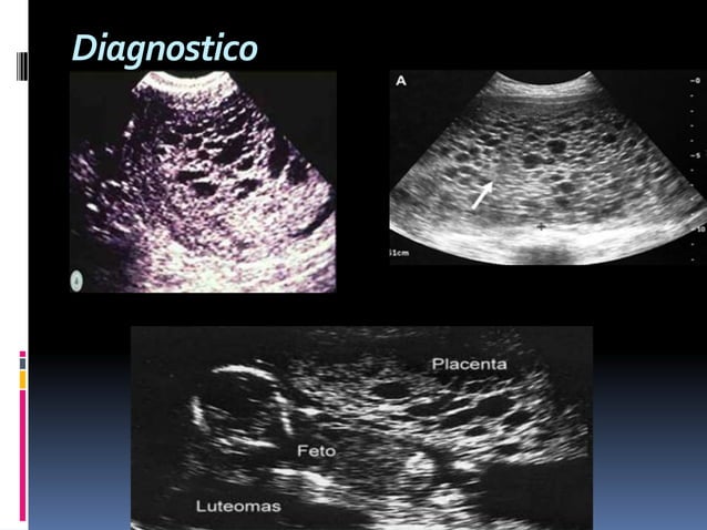 Mola hidatiforme | PPT
