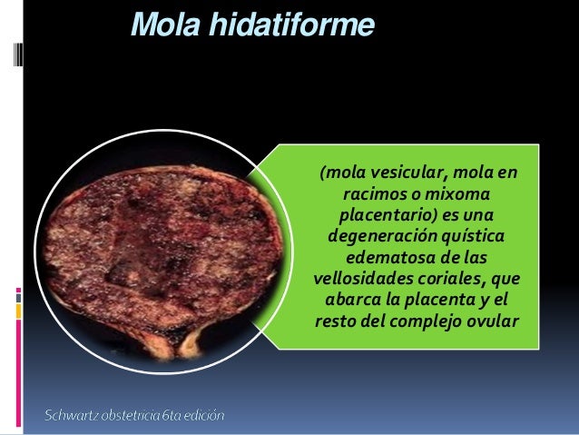 Mola hidatiforme