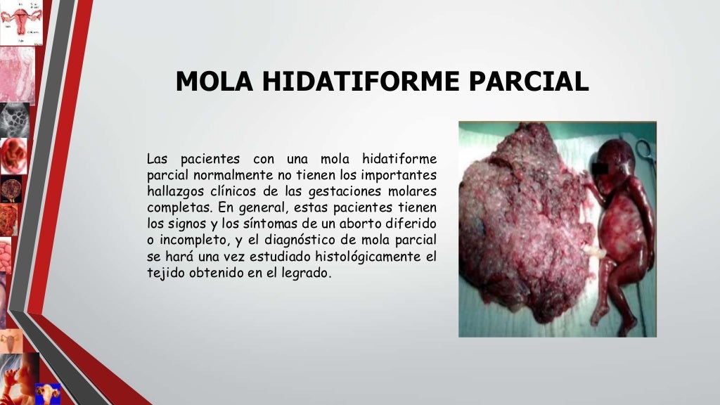Mola hidatiforme