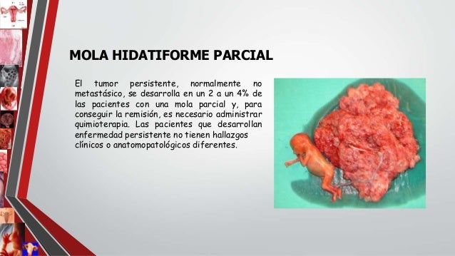 Mola hidatiforme