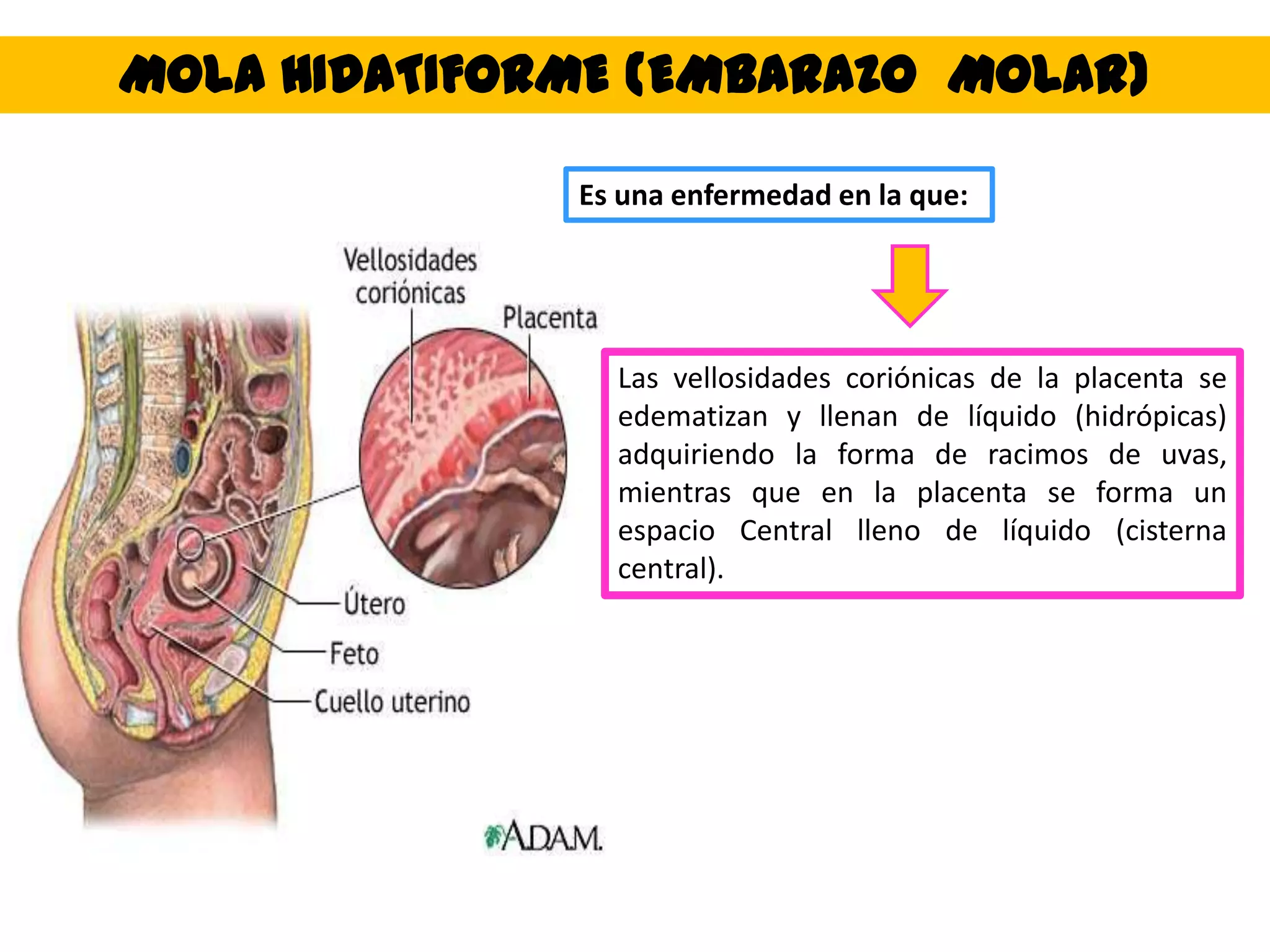 Mola hidatiforme, cuidados de enfermeria y DIAGNOSTICOS NANDA | PPTX