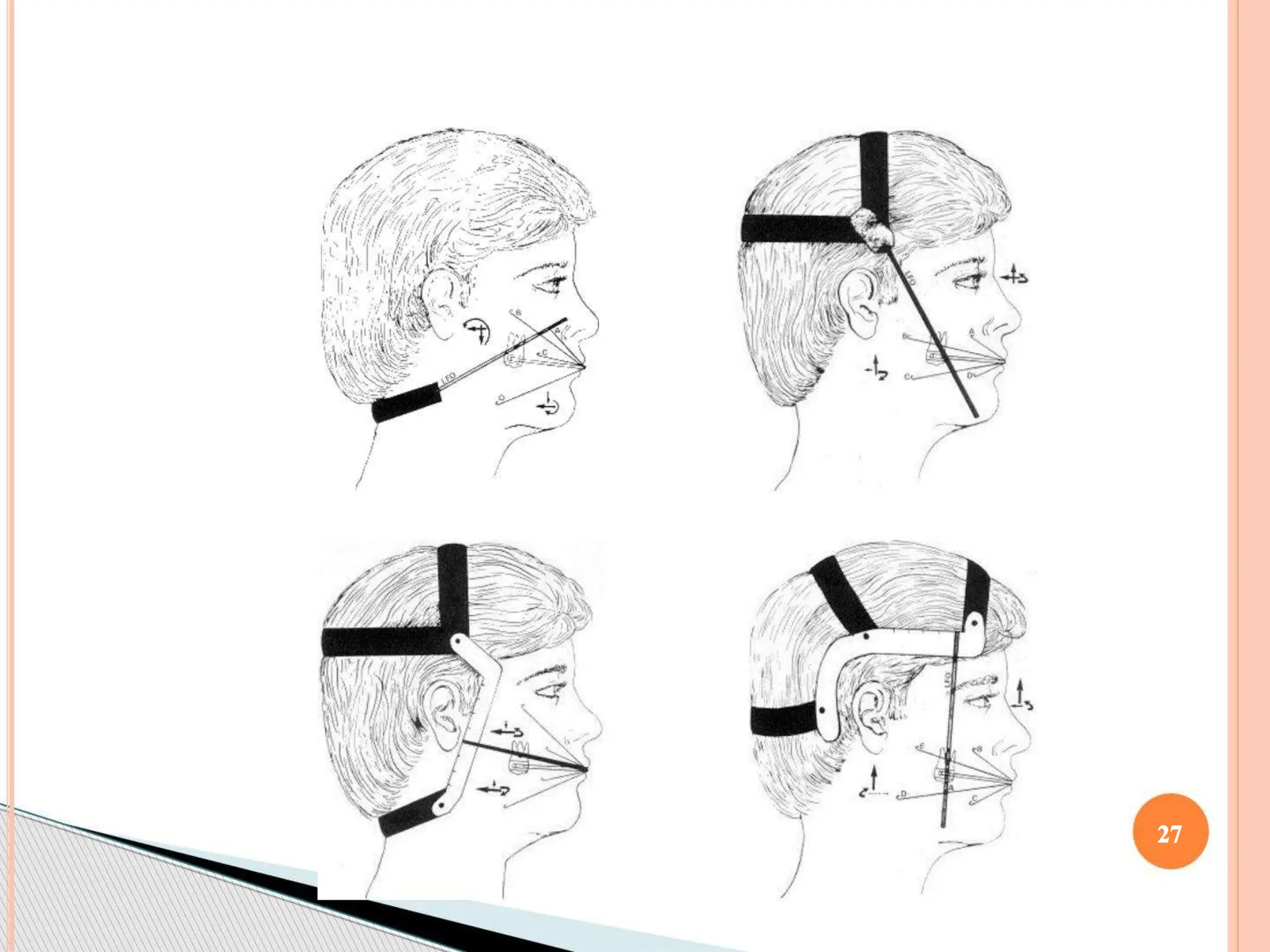 molar-distalization in orthodontics-seminar.pptx | Dental Health ...