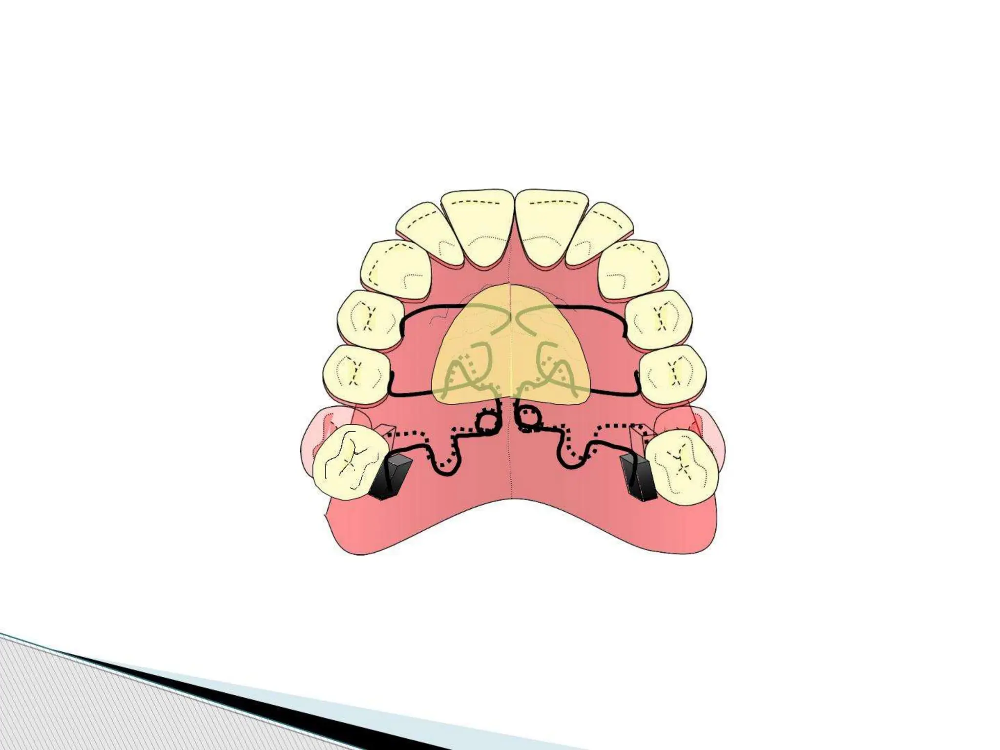 molar-distalization in orthodontics-seminar.pptx | Dental Health ...