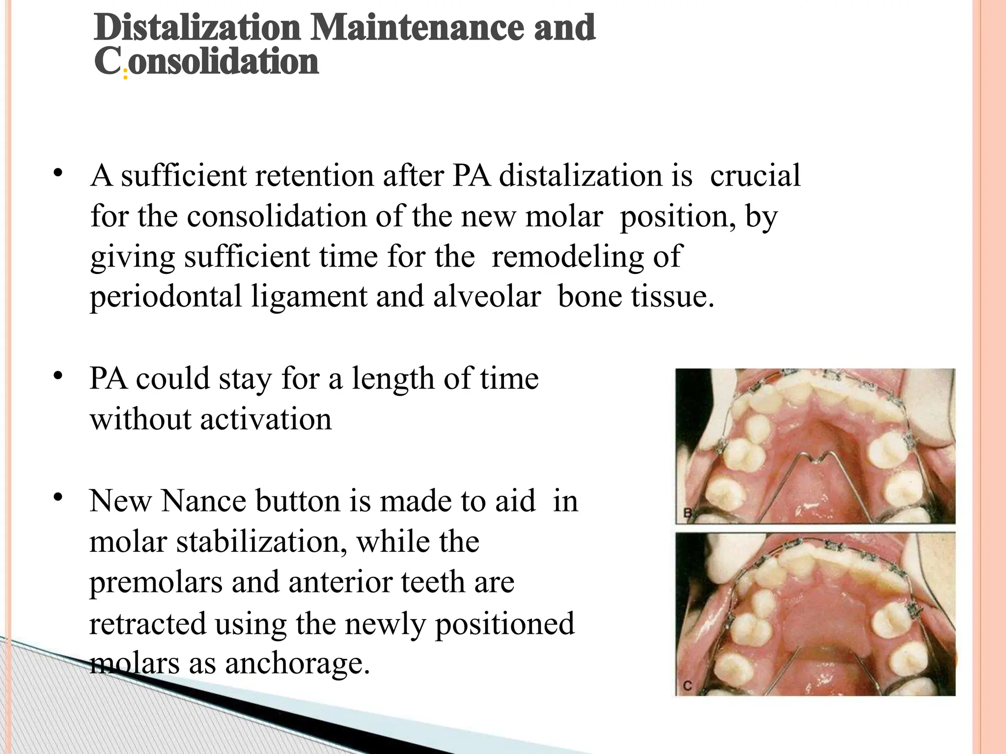 molar-distalization in orthodontics-seminar.pptx | Dental Health ...