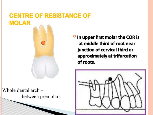 molar-distalization in orthodontics-seminar.pptx | Dental Health ...