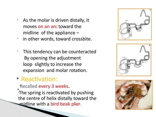 molar-distalization in orthodontics-seminar.pptx | Dental Health ...
