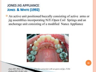 molar-distalization in orthodontics-seminar.pptx