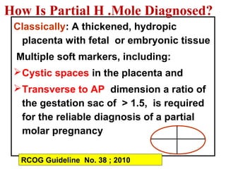 Molar pregnancy | PPT