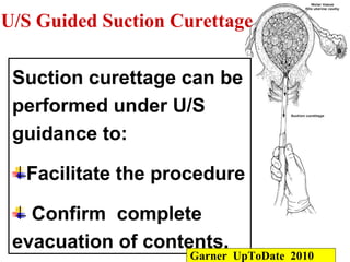 Suction Curettage Molar Pregnancy