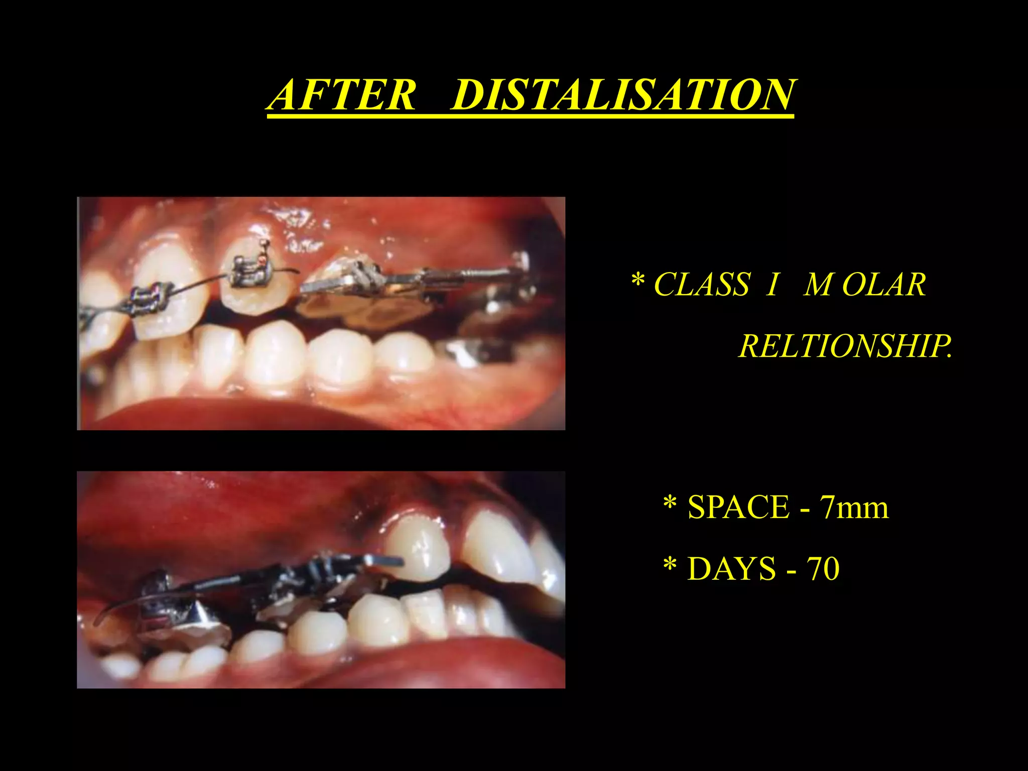 Molar distalisation/fixed orthodontic courses by indian dental academy ...