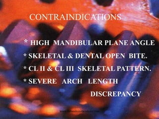 Molar distalisation/fixed orthodontic courses by indian dental academy ...