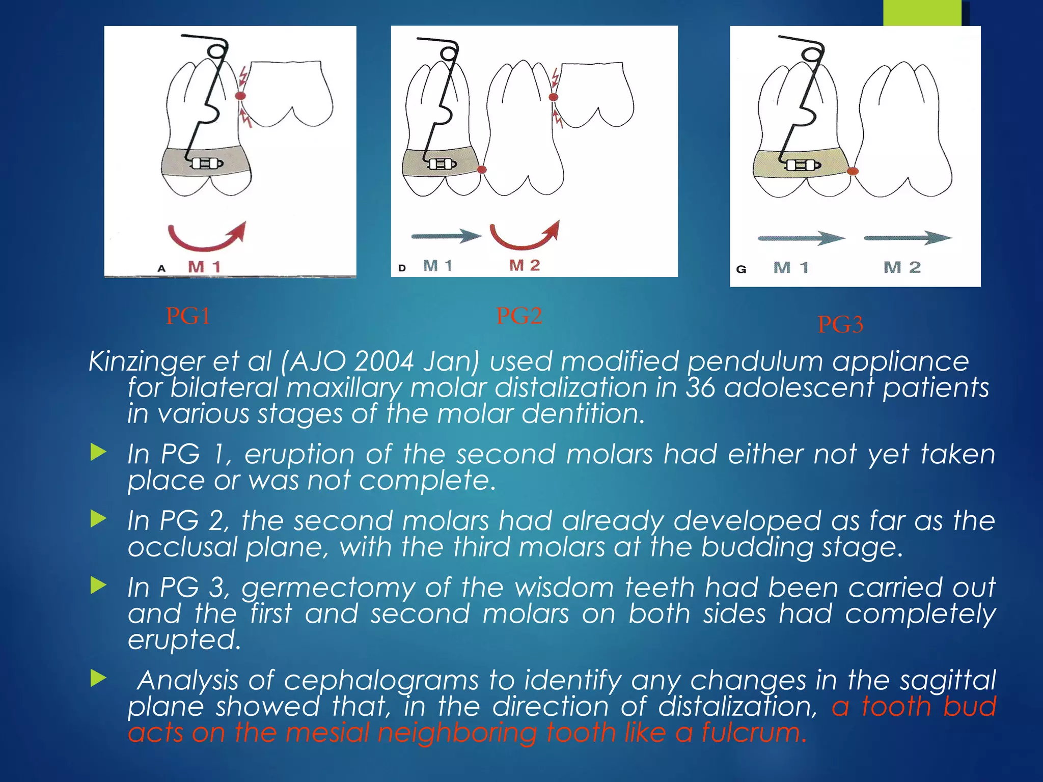 Molar distalisation | PPT