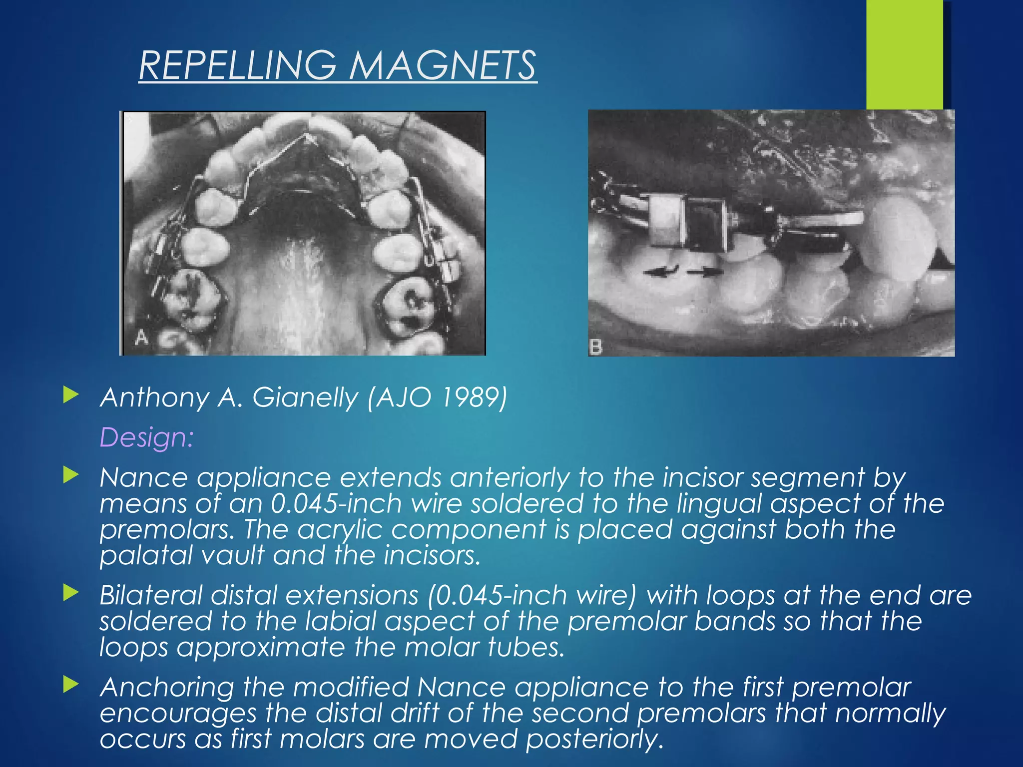 Molar distalisation | PPT