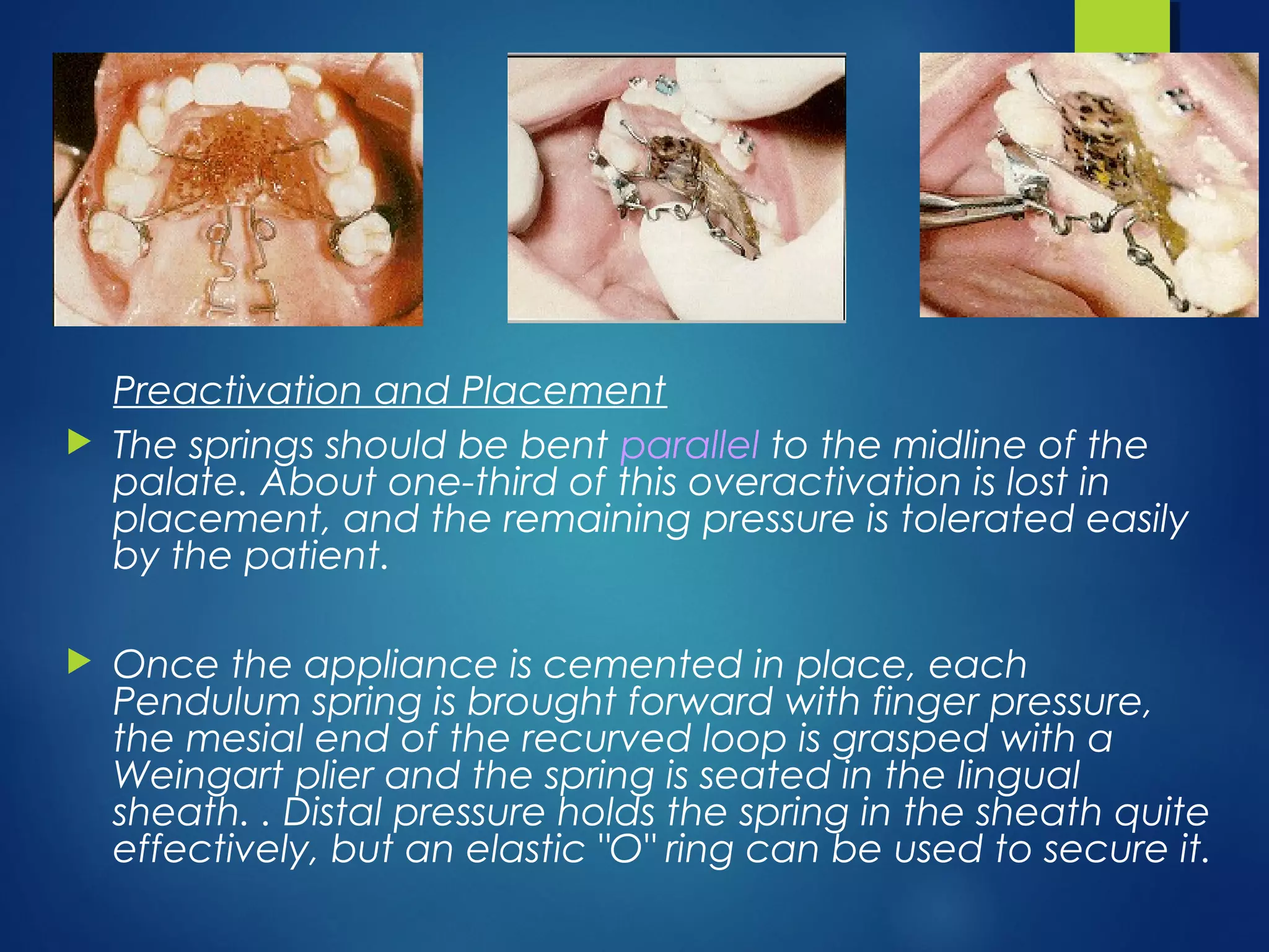 Molar distalisation | PPT