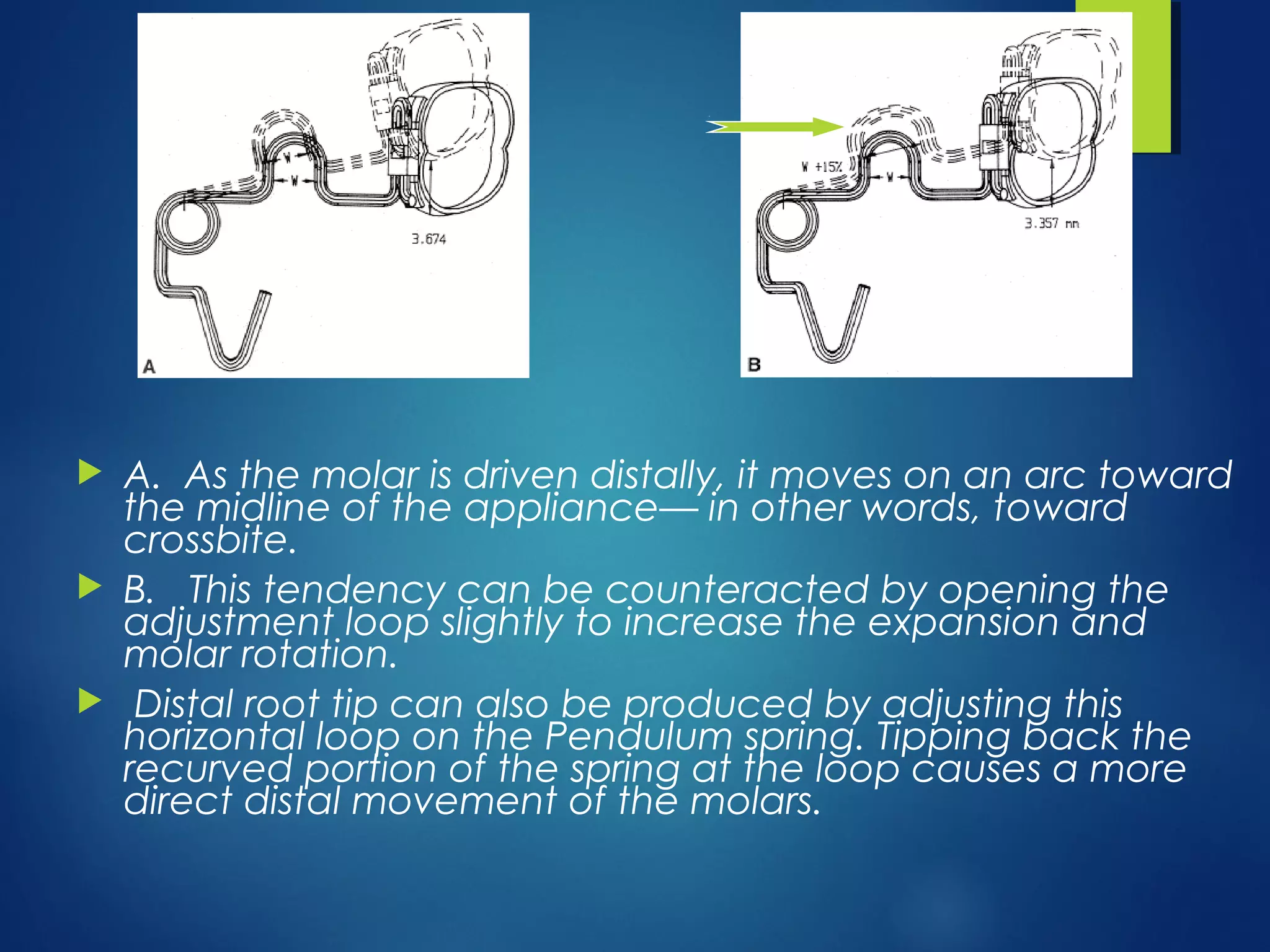 Molar distalisation | PPT