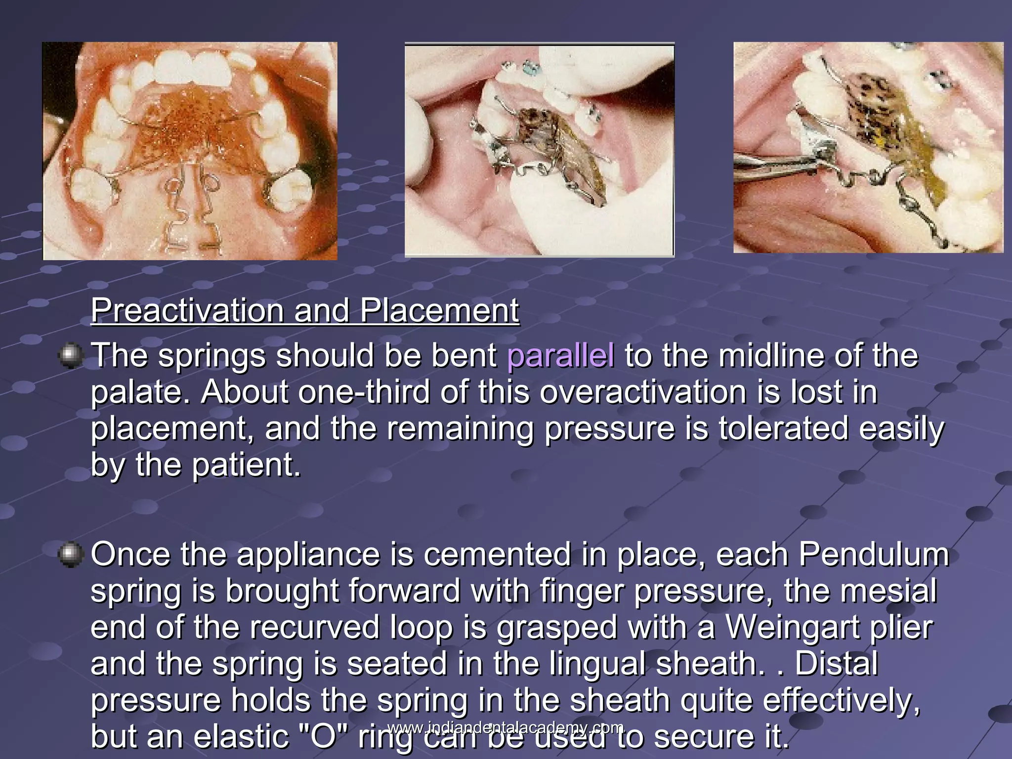 Molar distalisation | PPT