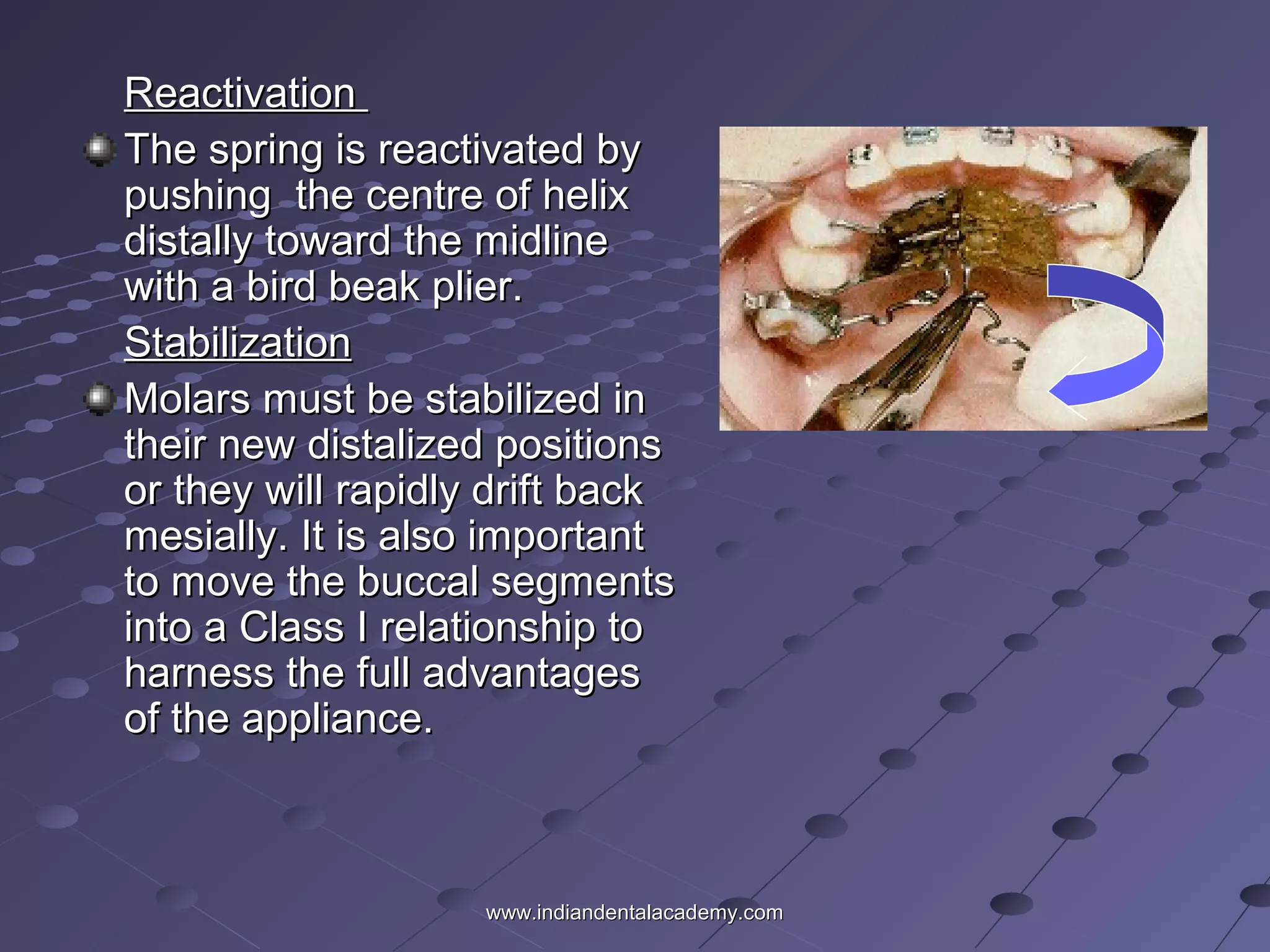 Molar distalisation | PPT