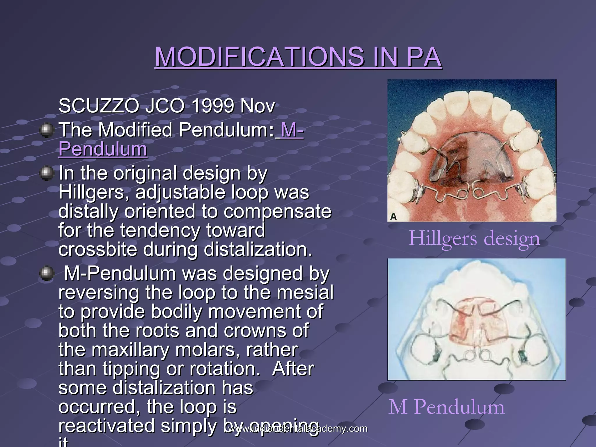Molar distalisation | PPT