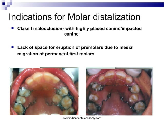Molar distalization /certified fixed orthodontic courses by Indian ...
